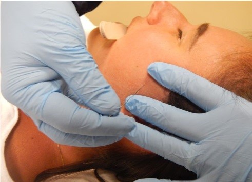 Trigger Point Dry Needling in the Treatment of TMD | Treating TMJ